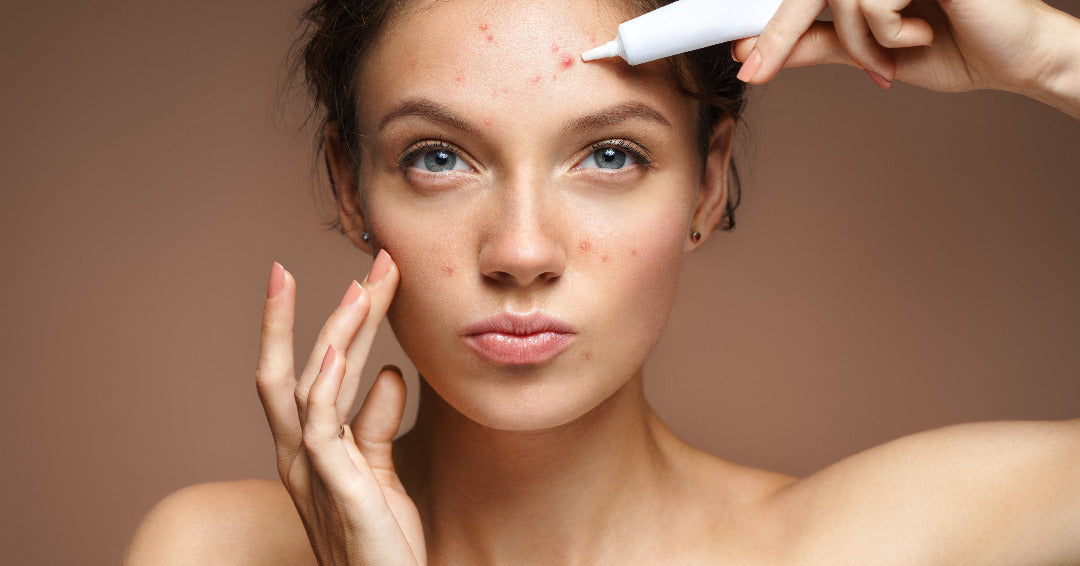Get Beautifully Clear Skin with Nabi-Beauty´s Anti-Acne Products for Women | Shop Now at www ...